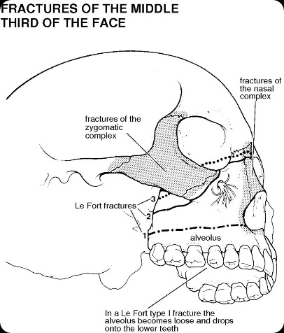 Cirurgia e Traumatologia BucoMaxiloFacial: Maxillofacial injuries
